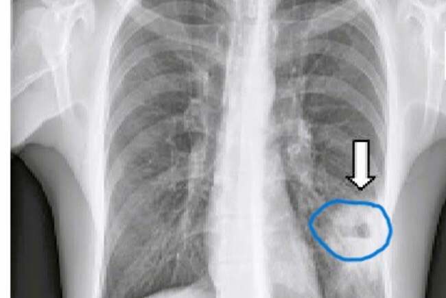 Abcesul pulmonar: care sunt simptomele și cum se depistează - Tion