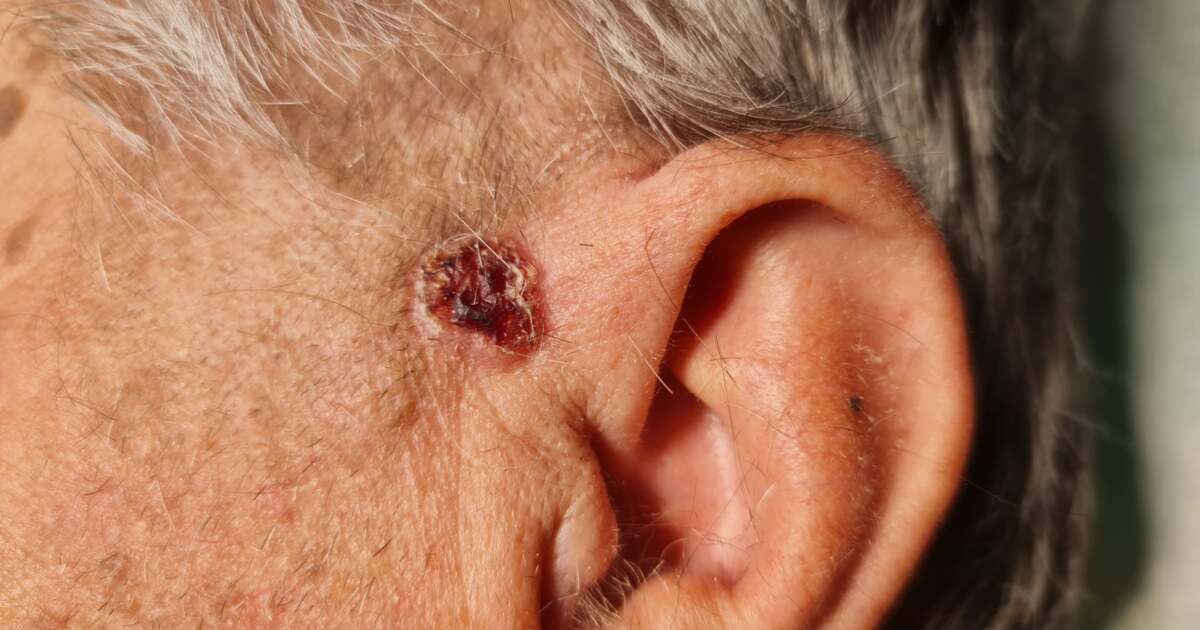 Cancerul de piele – tipuri de cancer de piele - Tion