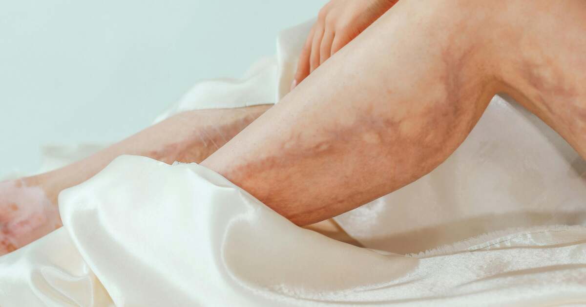 Picioare umflate și varice dureroase? Semnele care vă trimit la medicul ...